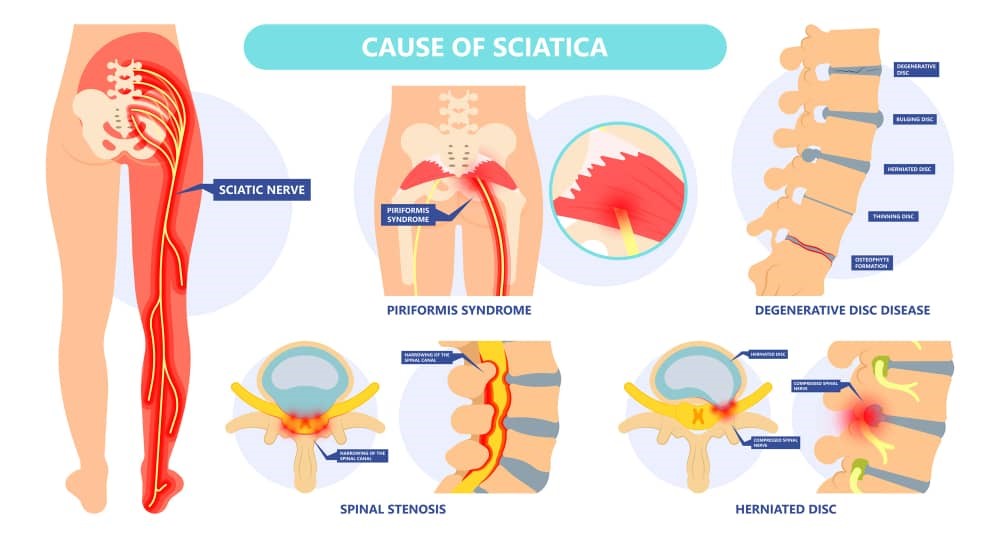 5 Reasons Why Sciatica Pain Occur
