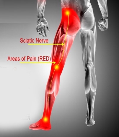 5 Reasons Why Sciatica Pain Occur