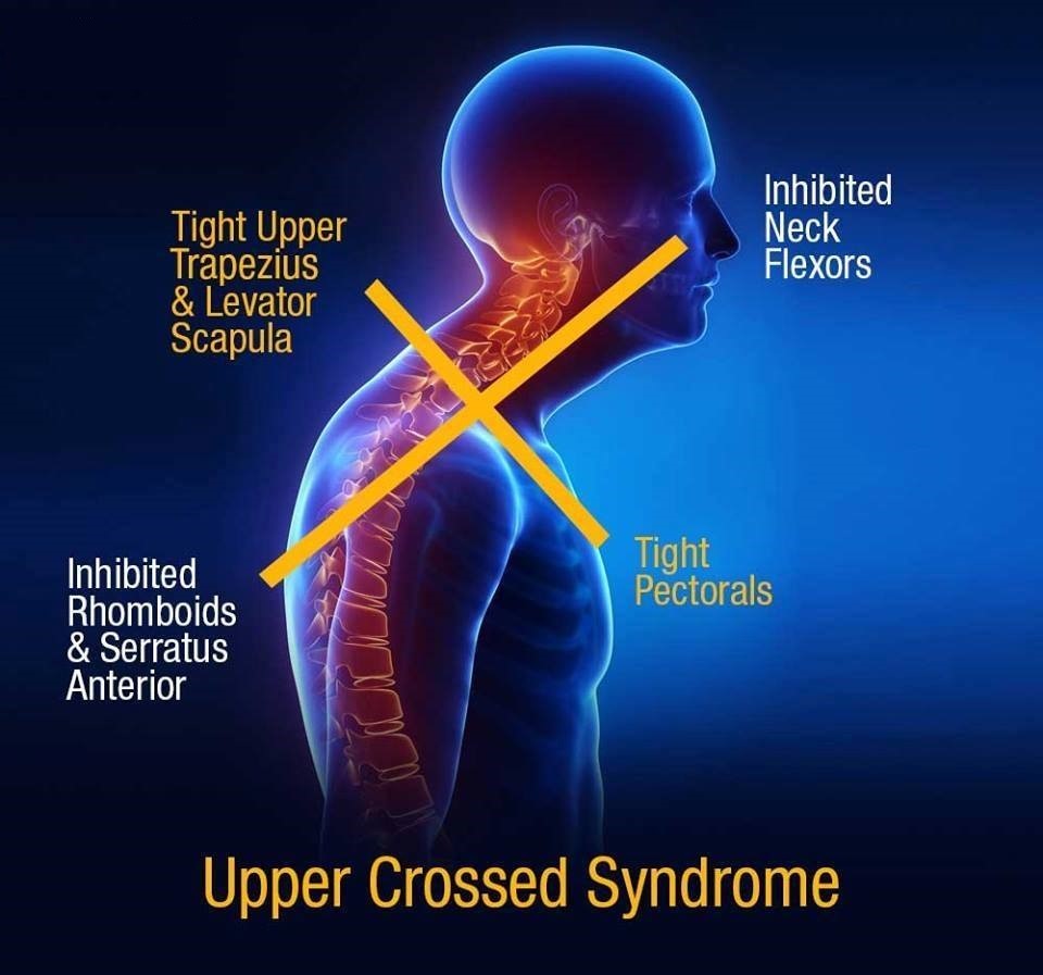 Causes of Upper Cross Syndrome: Understanding & Prevention